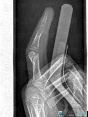 Radiology case : Fracture (X rays) - Diagnologic