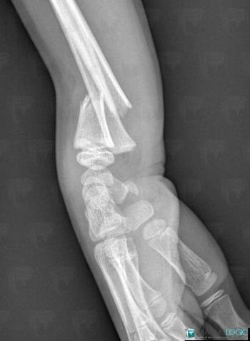 Radiology case : Fracture (X rays) - Diagnologic