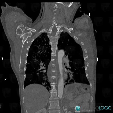 Radiology case : Fracture (CT) - Diagnologic