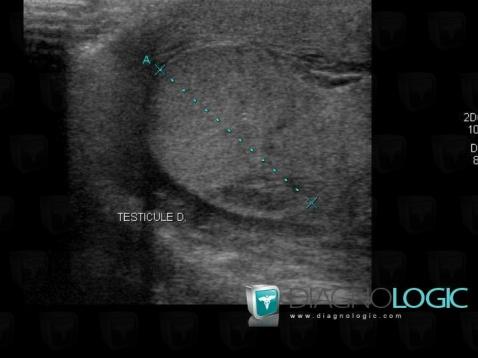 Radiology case : Fracture (US) - Diagnologic