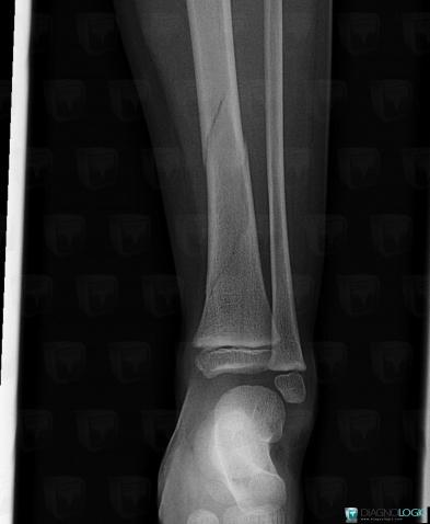Radiology case : Fracture (X rays) - Diagnologic