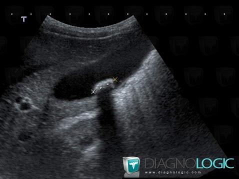 Radiology case : Gallstone (US) - Diagnologic