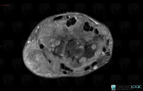 Cas radiologie : Goutte (IRM) - Diagnologic