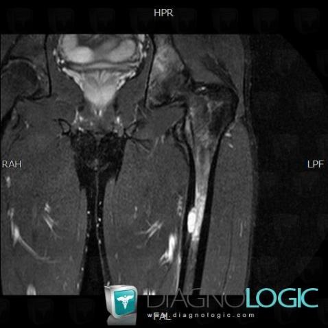 Cas radiologie : Histiocytose à cellules de Langerhans (Scanner ,IRM ...