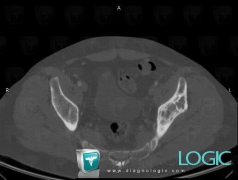 Cas radiologie : Histiocytose à cellules de Langerhans (Scanner ...