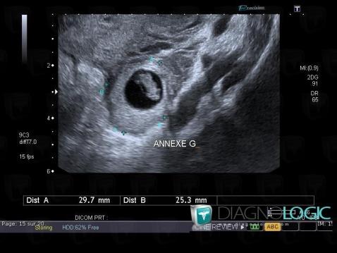 Cas radiologie : Grossesse extra-utérine (Echographie) - Diagnologic