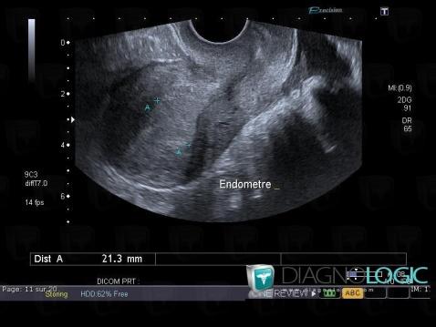 Cas radiologie : Grossesse extra-utérine (Echographie) - Diagnologic