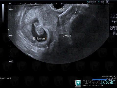 Cas radiologie : Grossesse (Echographie) - Diagnologic