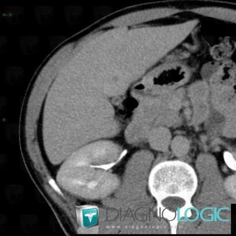 Radiology Case Hemangioma Ct Diagnologic