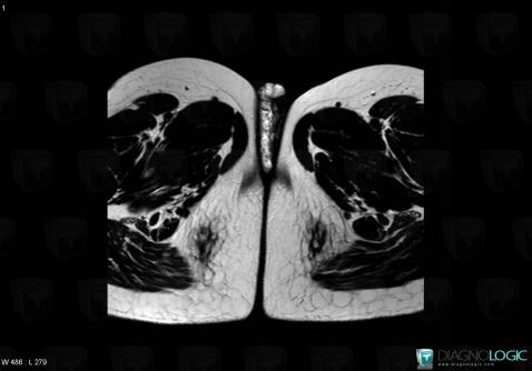 Radiology Case Hemangioma Mri Diagnologic