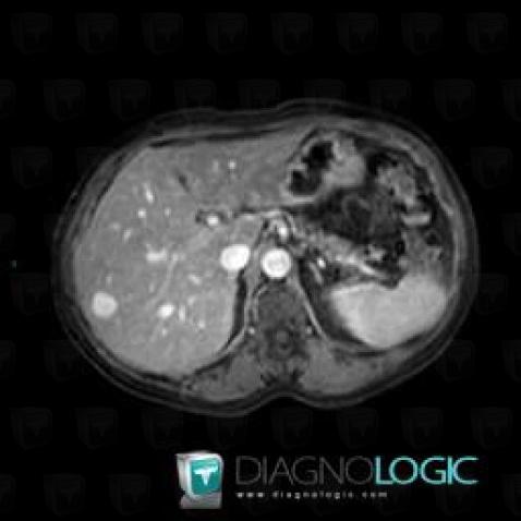 Cas radiologie : Hémangiome (IRM) - Diagnologic