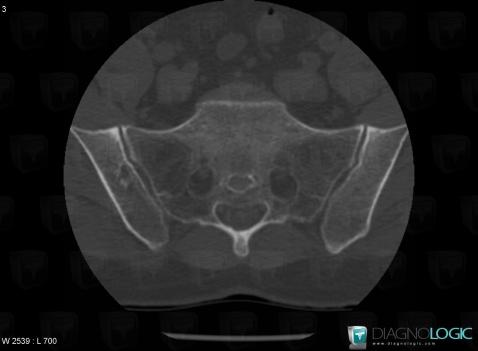 Cas radiologie : Hémangiome (Scanner ,IRM) - Diagnologic