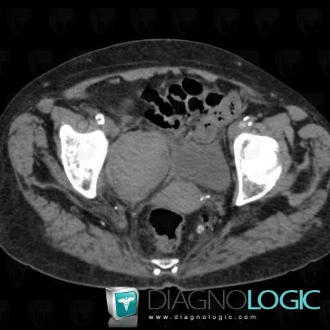 Radiology case : Fracture (CT) - Diagnologic