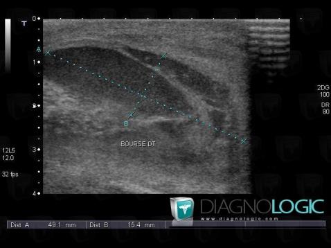 Radiology case : Fracture (US) - Diagnologic