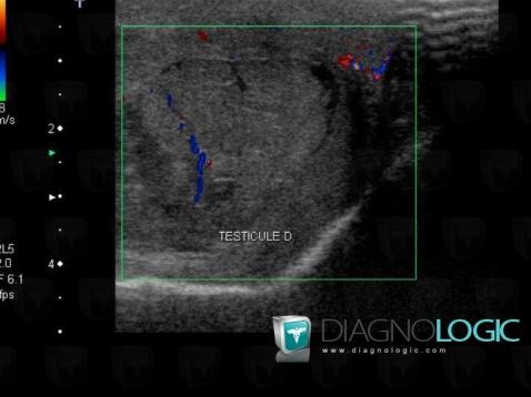 Radiology case : Fracture (US) - Diagnologic