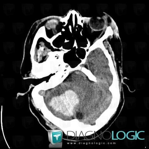 Cas radiologie : Hydrocéphalie (Scanner) - Diagnologic