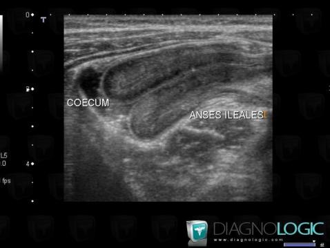 Cas radiologie : Purpura rhumatoïde (Echographie) - Diagnologic