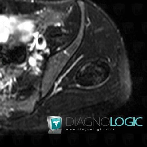 Cas radiologie : Hémophilie (Echographie ,IRM ,Scanner) - Diagnologic