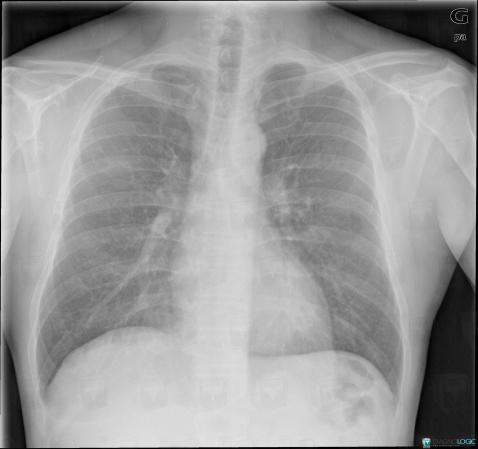 Cas radiologie : Emphysème paraseptal (Scanner ,Radio) - Diagnologic