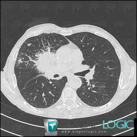 Cas radiologie : Emphysème centrolobulaire (Scanner) - Diagnologic