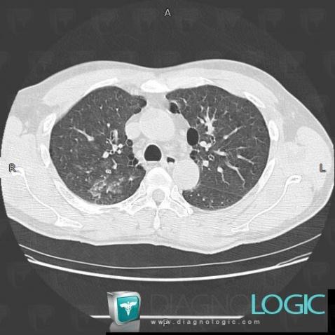 Cas radiologie : Emphysème paraseptal (Scanner ,Radio) - Diagnologic