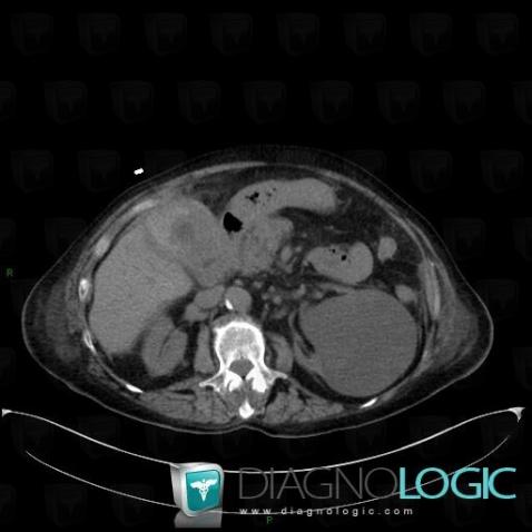 Radiology case : Hemorrhagic cholecystitis (CT) - Diagnologic