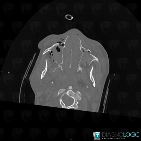 Radiology case : Hemosinus (CT) - Diagnologic