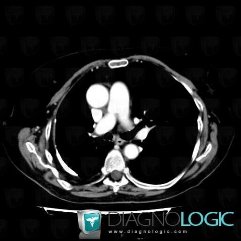 Radiology case : Hemothorax (CT) - Diagnologic