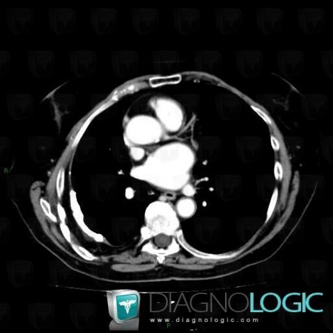 Radiology case : Hemothorax (CT) - Diagnologic
