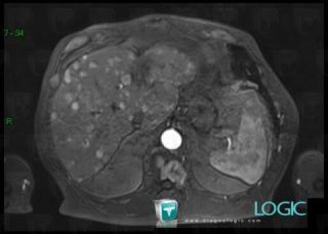 Radiology case : Hepatocellular carcinoma (MRI) - Diagnologic