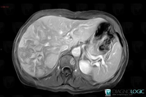 Radiology case : Hereditary hemorrhagic telangiectasia (CT ,MRI ...