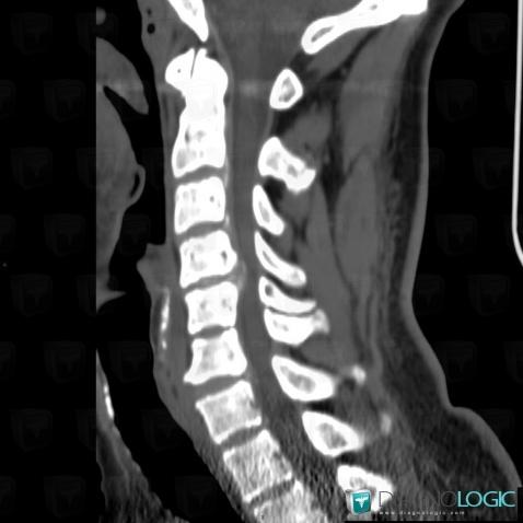 Cas radiologie : Hernie discale / Saillie discale focale (Scanner ...