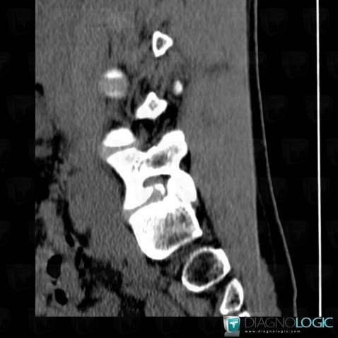 Cas radiologie : Hernie discale / Saillie discale focale (Scanner ...