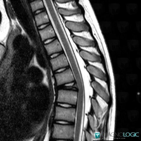 Cas radiologie : Histiocytose à cellules de Langerhans (IRM) - Diagnologic