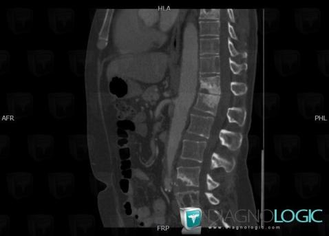Cas radiologie : Histiocytose à cellules de Langerhans (Scanner ...