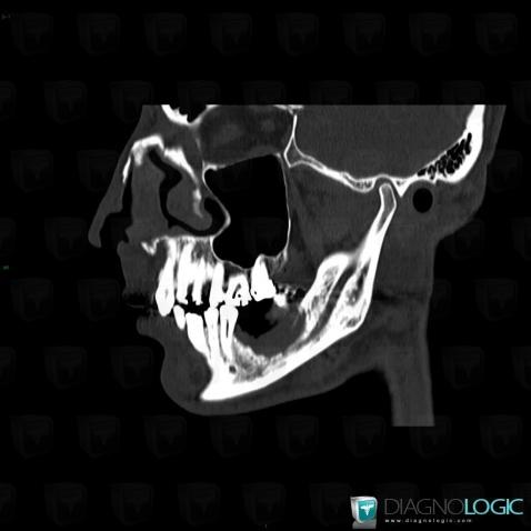 Cas radiologie : Histiocytose à cellules de Langerhans (Scanner ...