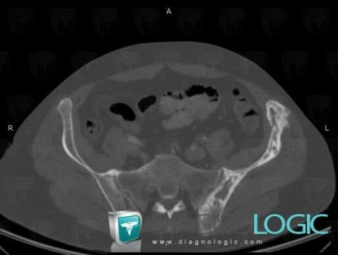 Cas radiologie : Histiocytose à cellules de Langerhans (Scanner ...