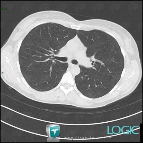 Cas radiologie : Histiocytose à cellules de Langerhans (Scanner ...