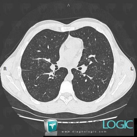 Cas radiologie : Histiocytose à cellules de Langerhans (Scanner ,IRM ...