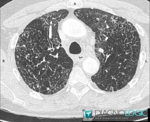 Cas radiologie : Histiocytose à cellules de Langerhans (Scanner ...