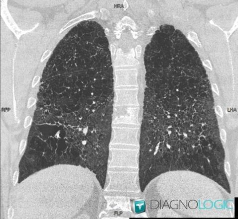 Cas radiologie : Histiocytose à cellules de Langerhans (Scanner ...