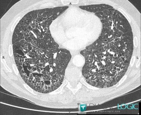 Cas radiologie : Histiocytose à cellules de Langerhans (Scanner ...