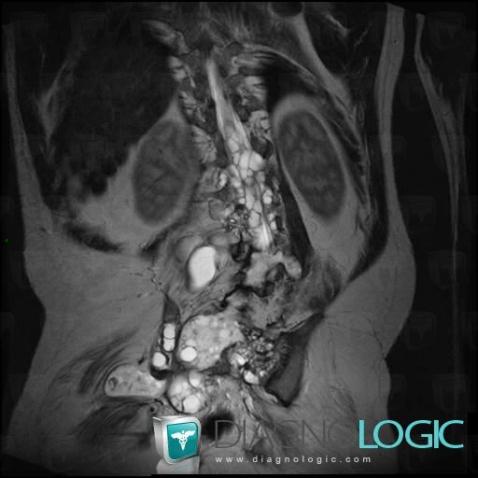 Radiology case : Hydatid disease (CT ,MRI) - Diagnologic