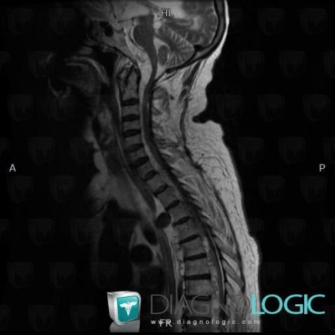Radiology case : Hydatid disease (CT ,MRI) - Diagnologic