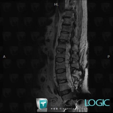 Radiology case : Hydatid disease (CT ,MRI) - Diagnologic