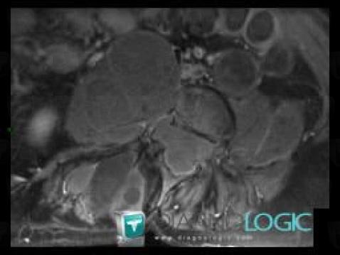 Cas radiologie : Hydatidose (Scanner ,IRM) - Diagnologic