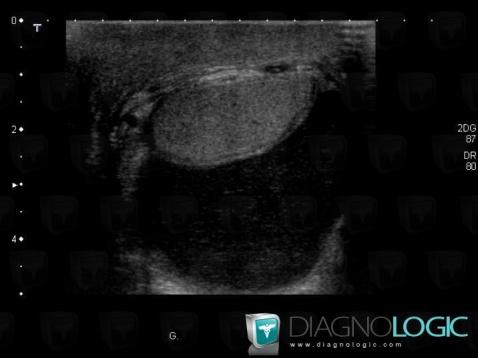 Radiology case : Hydrocele (US) - Diagnologic