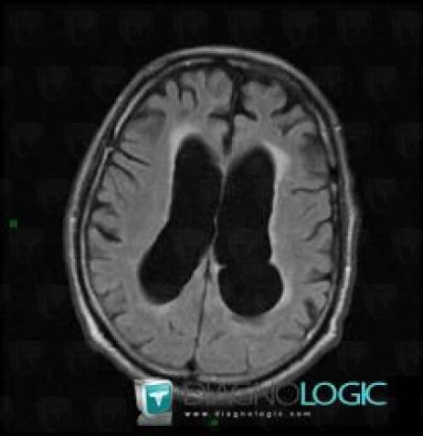 Cas radiologie : Hydrocéphalie à préssion normale (IRM) - Diagnologic