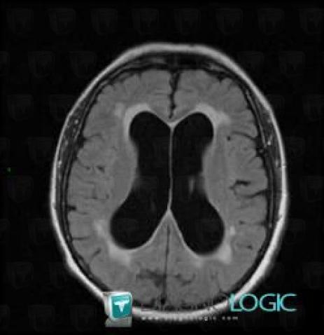 Cas radiologie : Hydrocéphalie - Diagnologic