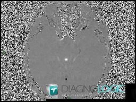 Cas radiologie : Hydrocéphalie (Scanner ,IRM) - Diagnologic
